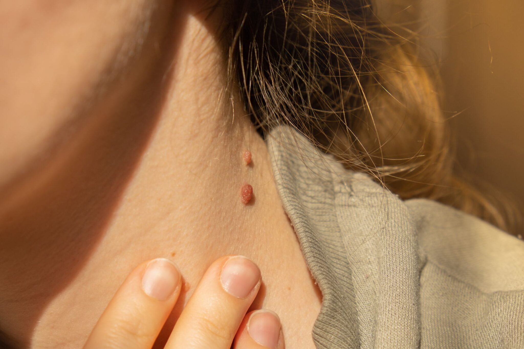 Skin tags: Why they develop, and how to remove them? - Dr Juvita