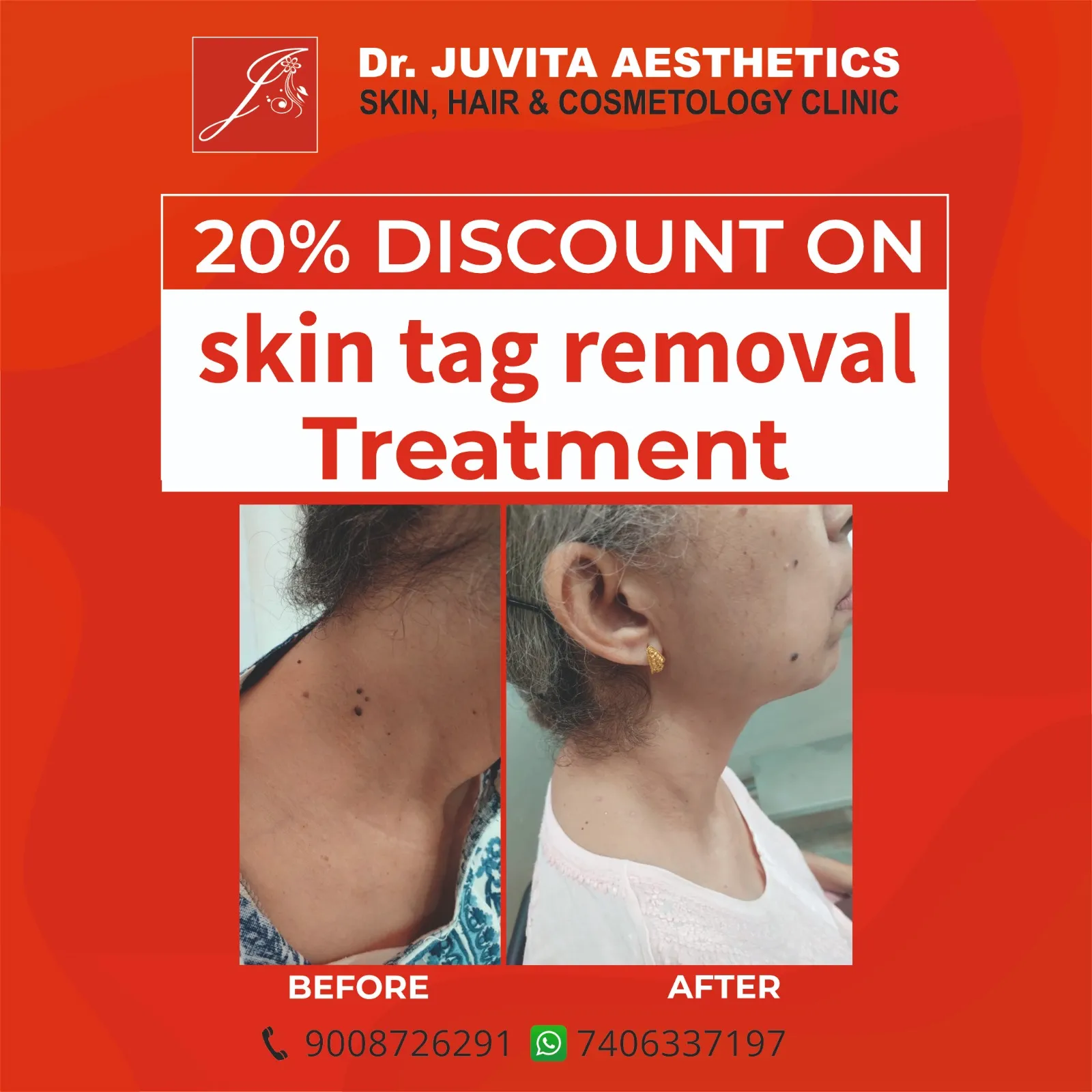 Dermatosis Papulosa Nigra - Dr Juvita